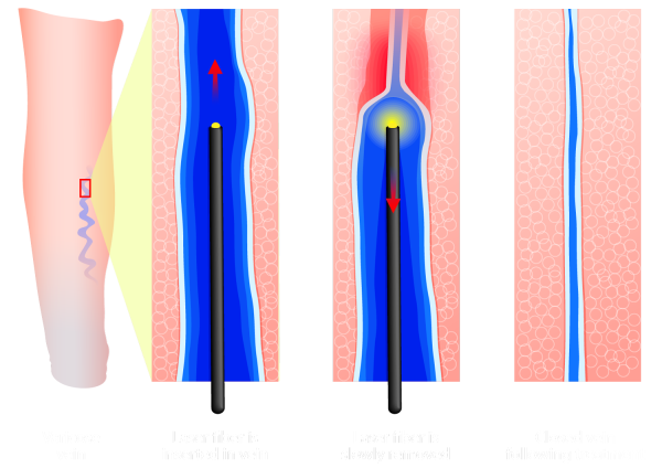 Endovenous Laser Ablation - Varicose Vein Removal