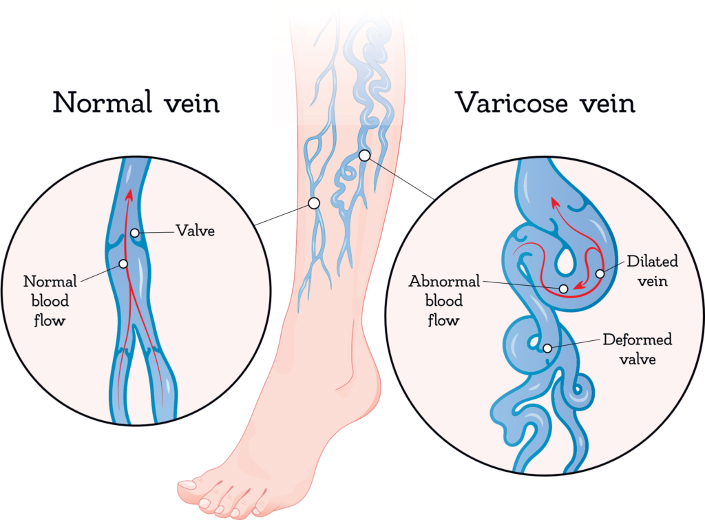 Successful Varicose Vein Treatment Sydney - Varicose Doctors Sydney