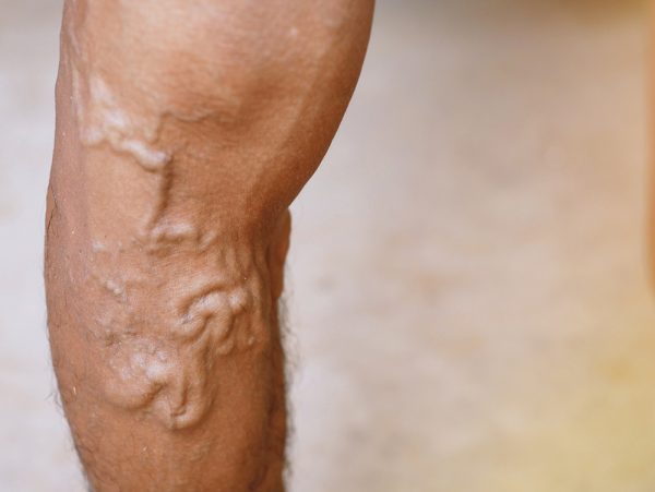 Does Smoking Cause Varicose Veins | Vein Doctors Sydney