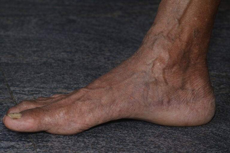 How To Treat Varicose Veins in Feet & Ankles | Vein Doctors