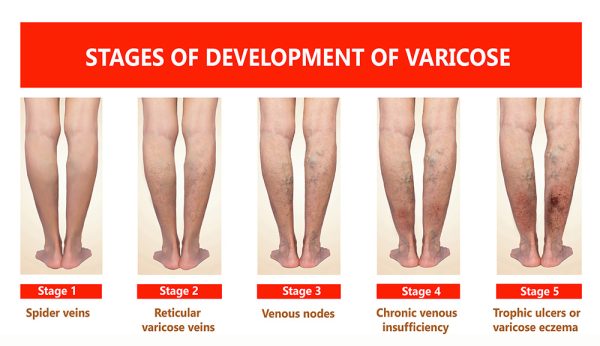 Varicose Veins Stages | Vein Doctors