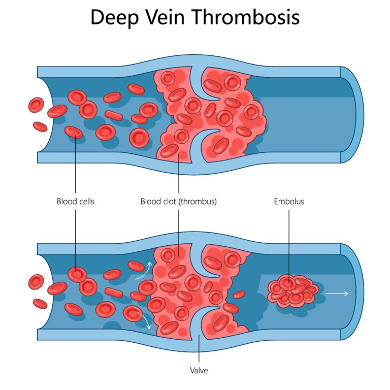 How to Check for a Blood Clot in Your Leg: Know the Signs