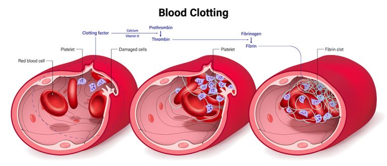 How to Check for a Blood Clot in Your Leg: Know the Signs
