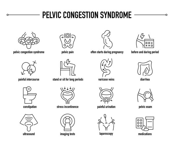 Pelvic Congestion Syndrome Symptoms and Causes